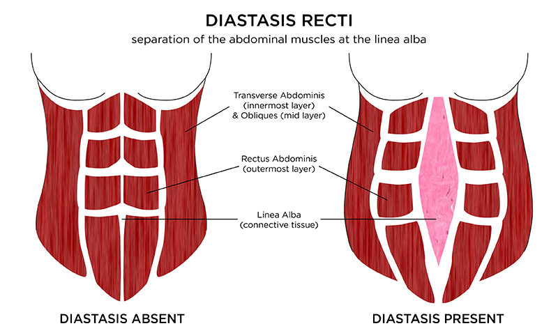 How to Check Yourself for Diastasis Recti - Diary of a Fit Mommy
