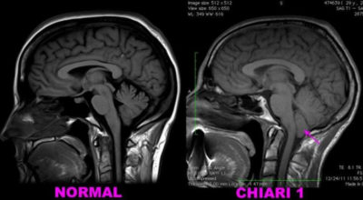 When Your Brain is Falling Out: My Chiari Diagnosis - Diary of a Fit Mommy